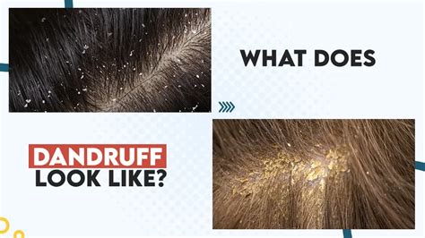 What Causes Dandruff Flakes