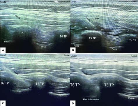 Anatomical View During Erector Spina Plane Block A B And Thoracic Download Scientific Diagram