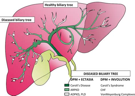 Congenital Hepatic Fibrosis Carolis Disease And Other Fibrocystic