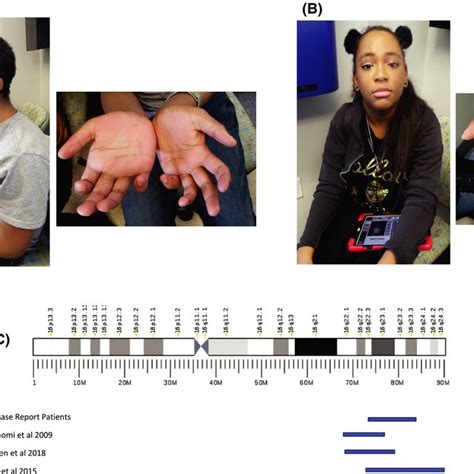 A Photographs Of Patient 1 Showing Dysmorphic Facial Features And 5th Download Scientific