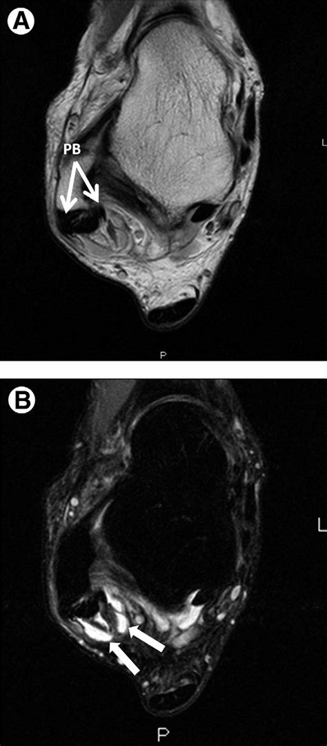 Peroneal Brevis Split Tear The Peroneal Brevis Pb Has Separated Into