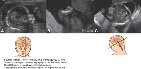 Microcephaly Ultrasound