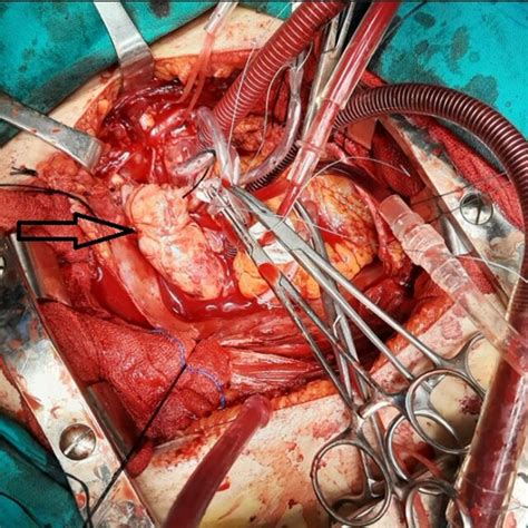 Intraoperative Image Of The Osteosarcoma Download Scientific Diagram