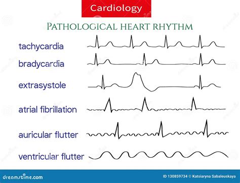 Pathological Ecg Collection Stock Illustration Illustration Of