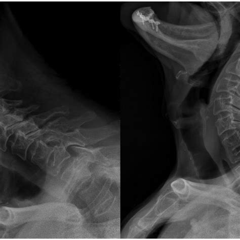 Flexion Extension Plain Radiograph Case 2 Download Scientific Diagram