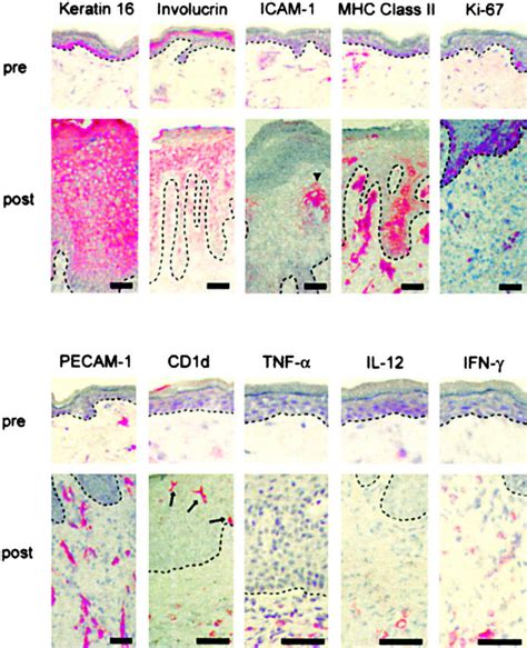 Epidermal Hyperproliferation Blood Vessel Formation And Immune