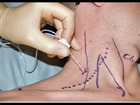 Interscalene Anatomy YouTube