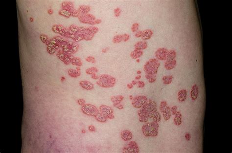 Early Stages Of Plaque Psoriasis Pmcwf