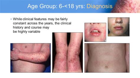 Atopic Dermatitis Strategies To Improve Outcomes Ages 6 18 Mild
