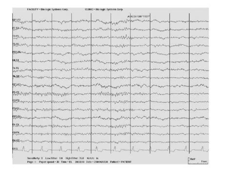 Eeg Variants With Patterns By Murtaza Syed