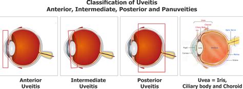 Uveitis Anjani Eye Hospital