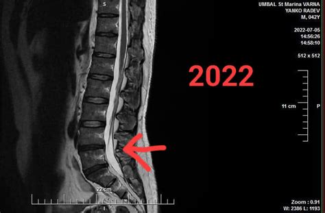 Редуцирана дискова херния на в кръста Център по рехабилитация и физиотерапия Торк