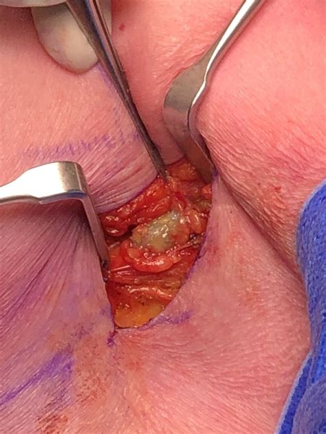 Why Remove Lymph Nodes