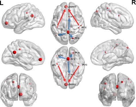 B Sketch Map Of The Between Group Differences In Causal Connectivity