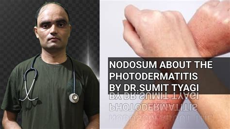 Nodosum About The Photodermatitis By Dr Sumit Tyagi Sumitmedicaldispensary1 Youtube