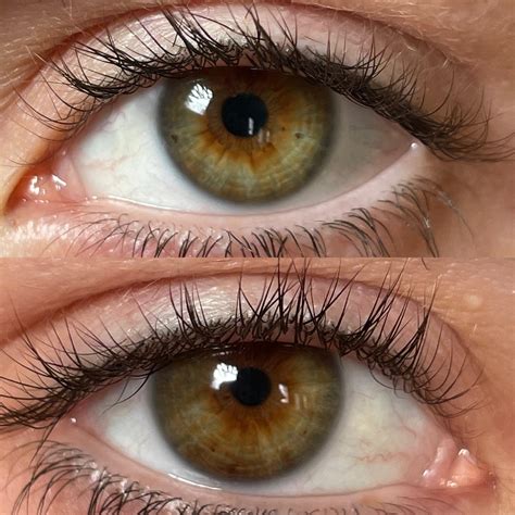 Hazel Or Central Heterochromia R Eyes