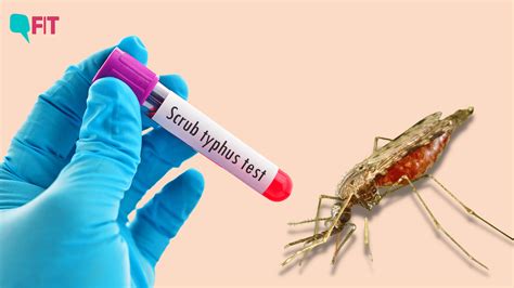 5 Scrub Typhus Deaths In Odisha 9 In Shimla What Is The Deadly Infection