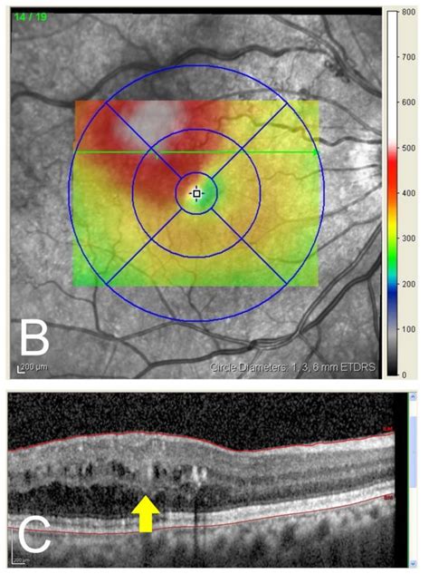 Investigating All Of The Hyperreflective Rings Microaneurysm On