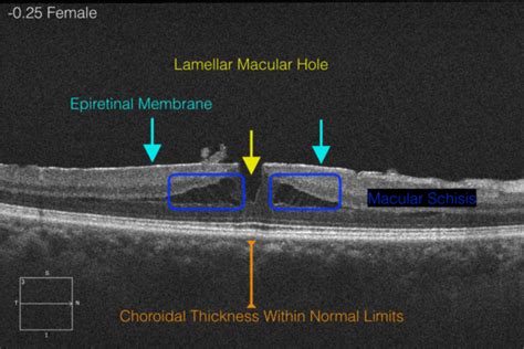 Lamellar Macular Hole Eyecarepd