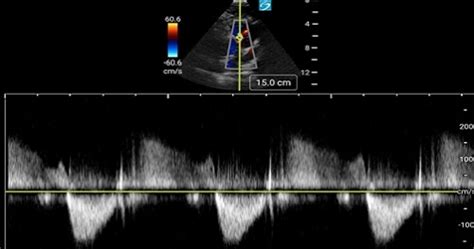 Cardiac Imaging Doppler Principles English Only Sonosite Institute For Point Of Care
