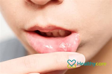 სტომატიტი და მისი მკურნალობა Ulcer Remedies Mouth Mouth Ulcers Mouth Ulcer Gel