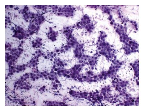 Frozen Section Of The Brain Mass Revealing Cryptococcoma Download