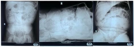 Imaging Bno 3 Position Shows Localized Ileus In The Upper To