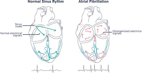 AFib Atrial Fibrillation Symptoms And Diagnosis Withings USA