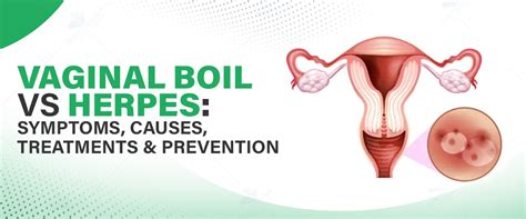 Vaginal Boil Vs Herpes Symptoms Causes Treatments And Prevention
