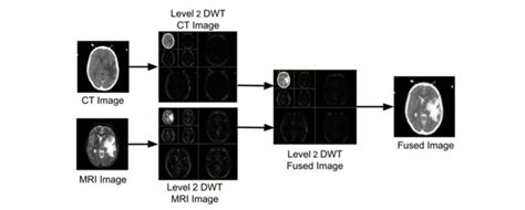 fusion of ct and mri images using 2nd level dwt and max rule based fusion