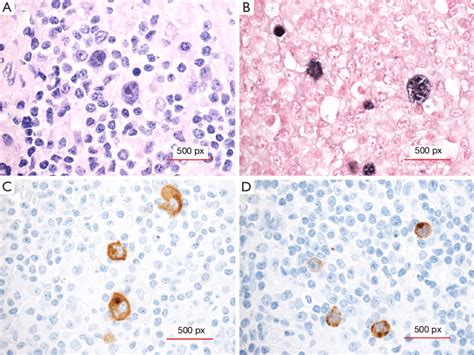 Lymph Node Excisional Biopsy Atypical Hodgkin Reed Sternberg Like Download Scientific Diagram