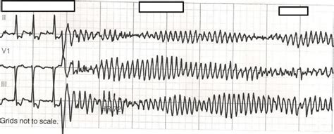 Torsades De Pointes Jetem