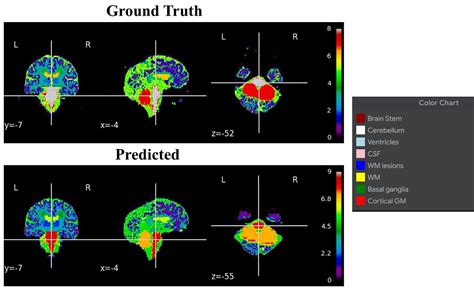 Brain Mri Segmentation Using Deep Learning By Abhijeet Khangarot