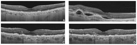 Macular Degeneration Oct