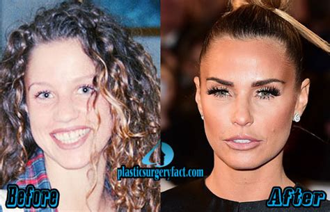 Katie Price Plastic Surgery Katie Price Before And After Veneers