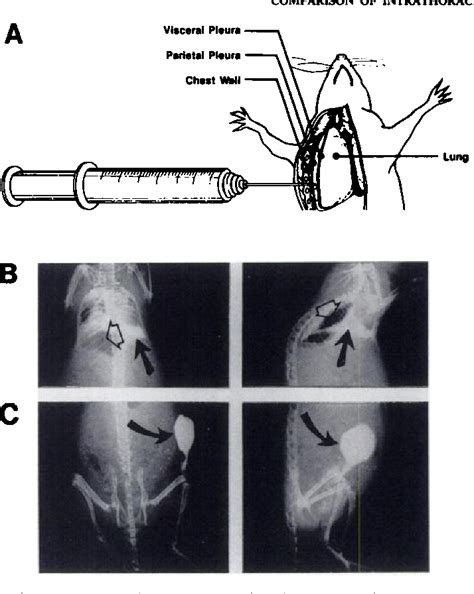 Figure 1 From Comparison Of Intrapulmonary Percutaneous Intrathoracic