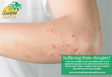Suffering From Shingles Suntree Internal Medicine
