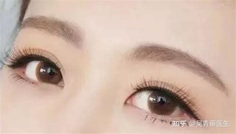 激光祛眼袋和手术祛眼袋哪种方法好 知乎