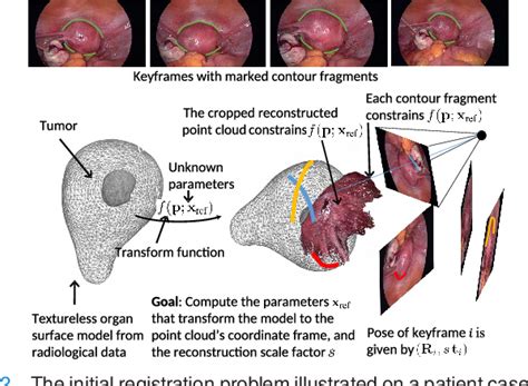 Figure 2 From Augmented Reality Guided Laparoscopic Surgery Of The
