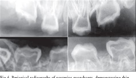 Dentinogenesis Imperfecta Semantic Scholar
