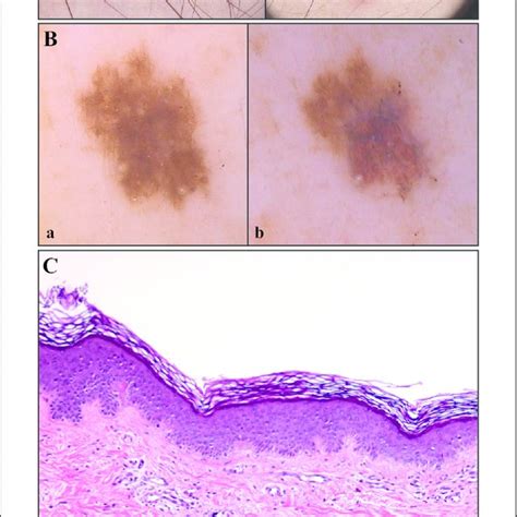 A Dermoscopic Pattern Of Dorsal Nevi In The Depilatory Field Download Scientific Diagram A Dermoscopic Pattern Of Dorsal Nevi In The Depilatory Field Download Scientific Diagram
