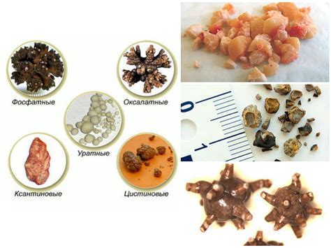 Литотрипсия время дробить камни Medadvisor