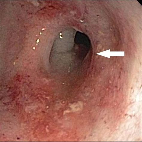 Surveillance Colonoscopy Showing A Tight Stricture In The Sigmoid Colon Download Scientific