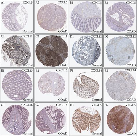 The Protein Expression Of Cxc Chemokine Vegfa Network In Coad Human