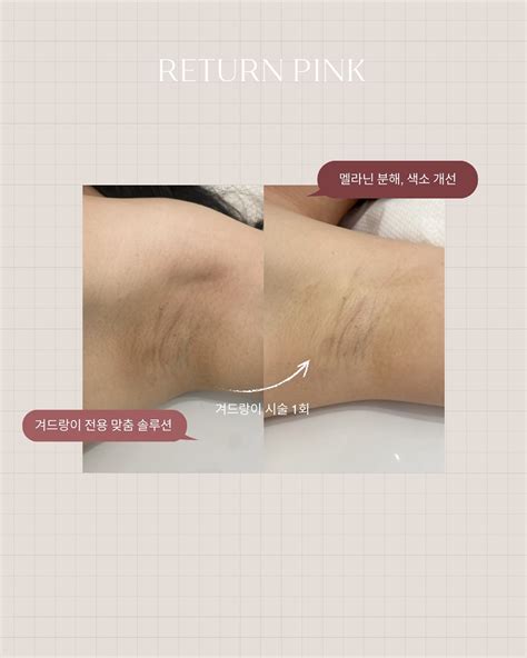 리턴핑크 수원점🩷 유륜미백•색소침착케어•멜라닌케어 수원팔꿈치미백 수원팔꿈치 ️ 부드럽고 환해진 팔꿈치 ️ 칙칙하고 각질