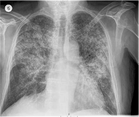 Diffuse Bilateral Perihilar Inhomogenous Infiltrates On Chest X Ray Download Scientific Diagram