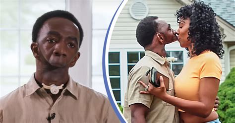 “she Cant Kiss Him ” Man With No Jaw Found True Love Yet Their Unique Bond Caused Controversy