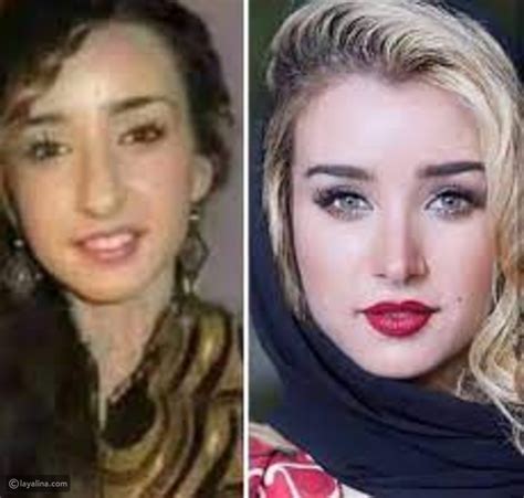 صورة لهنا الزاهد قبل وبعد التجميل تكشف كيف تبدلت ملامحها