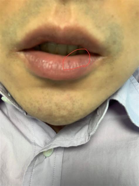 입술 검은 반점 질문 지식in