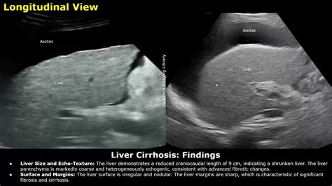 Liver Cirrhosis With Portal Hypertension Ascites And Splenomegaly Ultrasound Report Example Usg